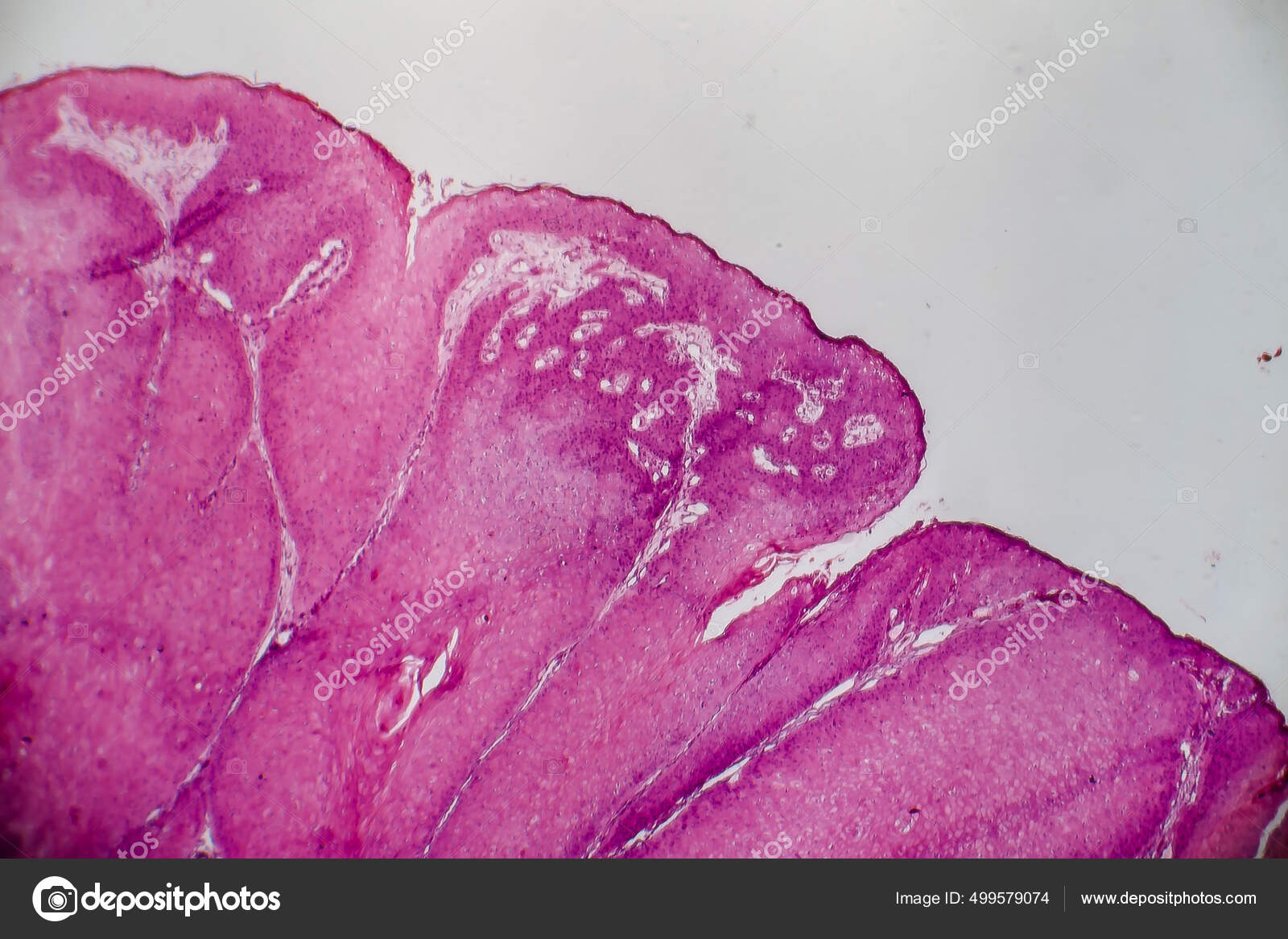 Condyloma Acuminatum Also Known Genital Warts Light Micrograph Photo ...