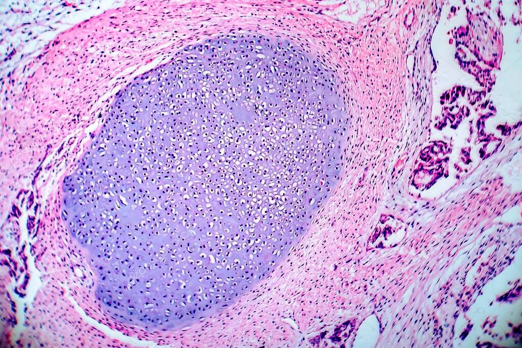 Light micrograph of teratoma, a tumor made up of several different ...