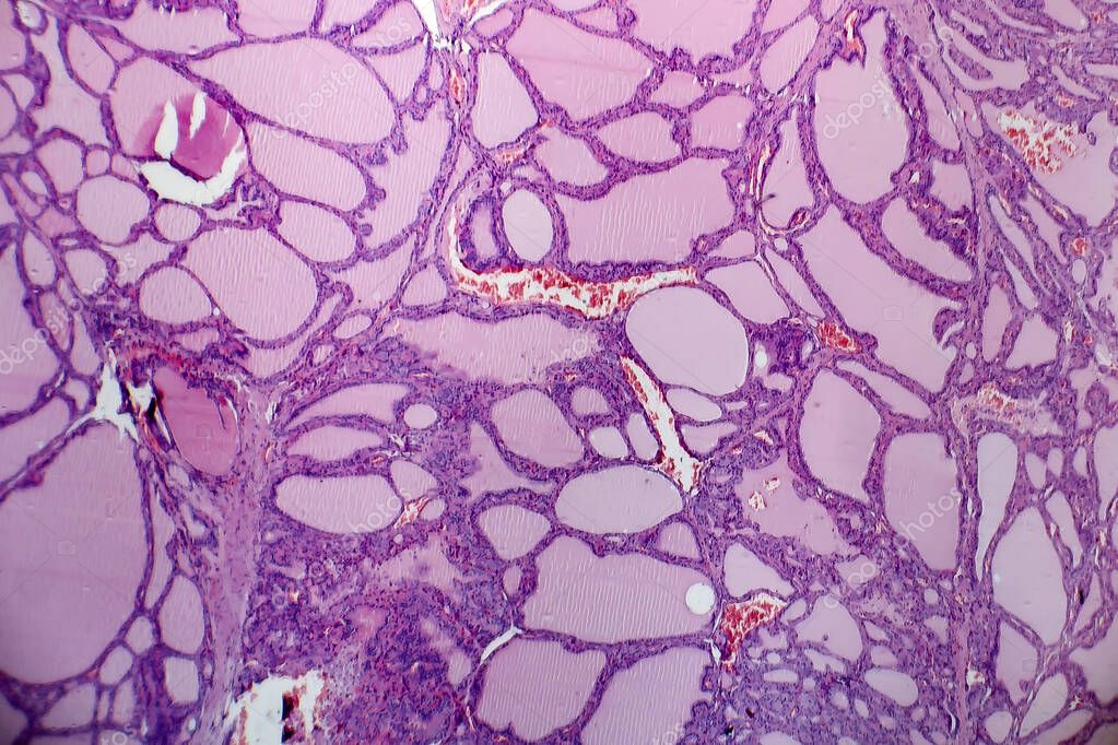 Bocio end mico, micrograf a ligera, aumento anormal de la gl ndula tiroides debido a la ...