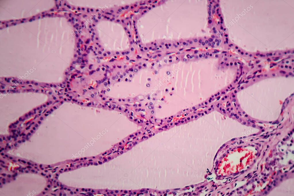 Bocio end mico, micrograf a ligera, aumento anormal de la gl ndula tiroides debido a la ...