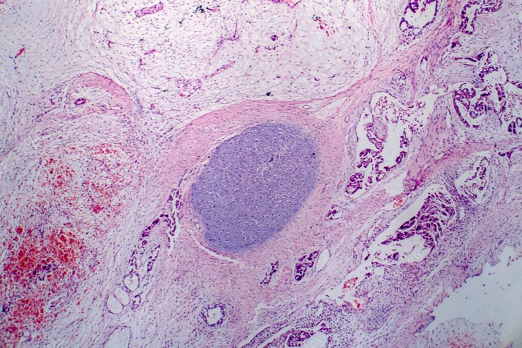 Light Micrograph Of Teratoma A Tumor Made Up Of Several Different