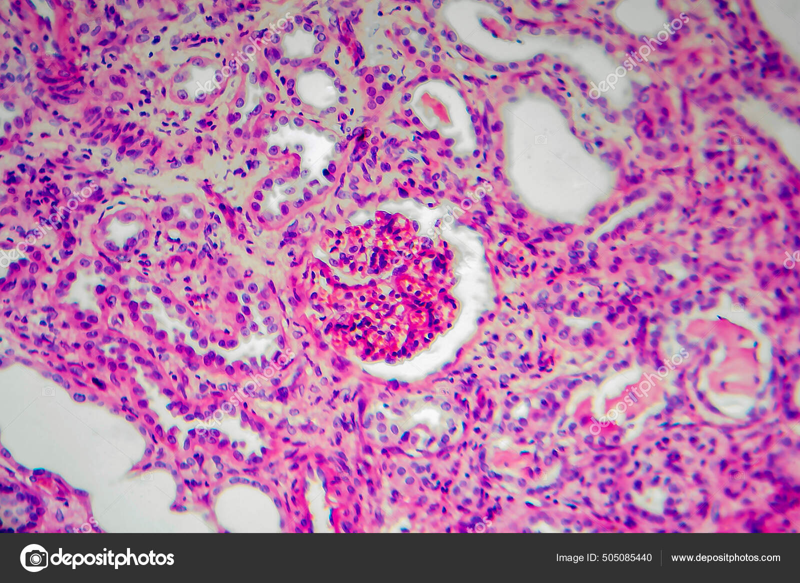 Chronic Pyelonephritis Light Micrograph Photo Microscope Stock Photo by ...