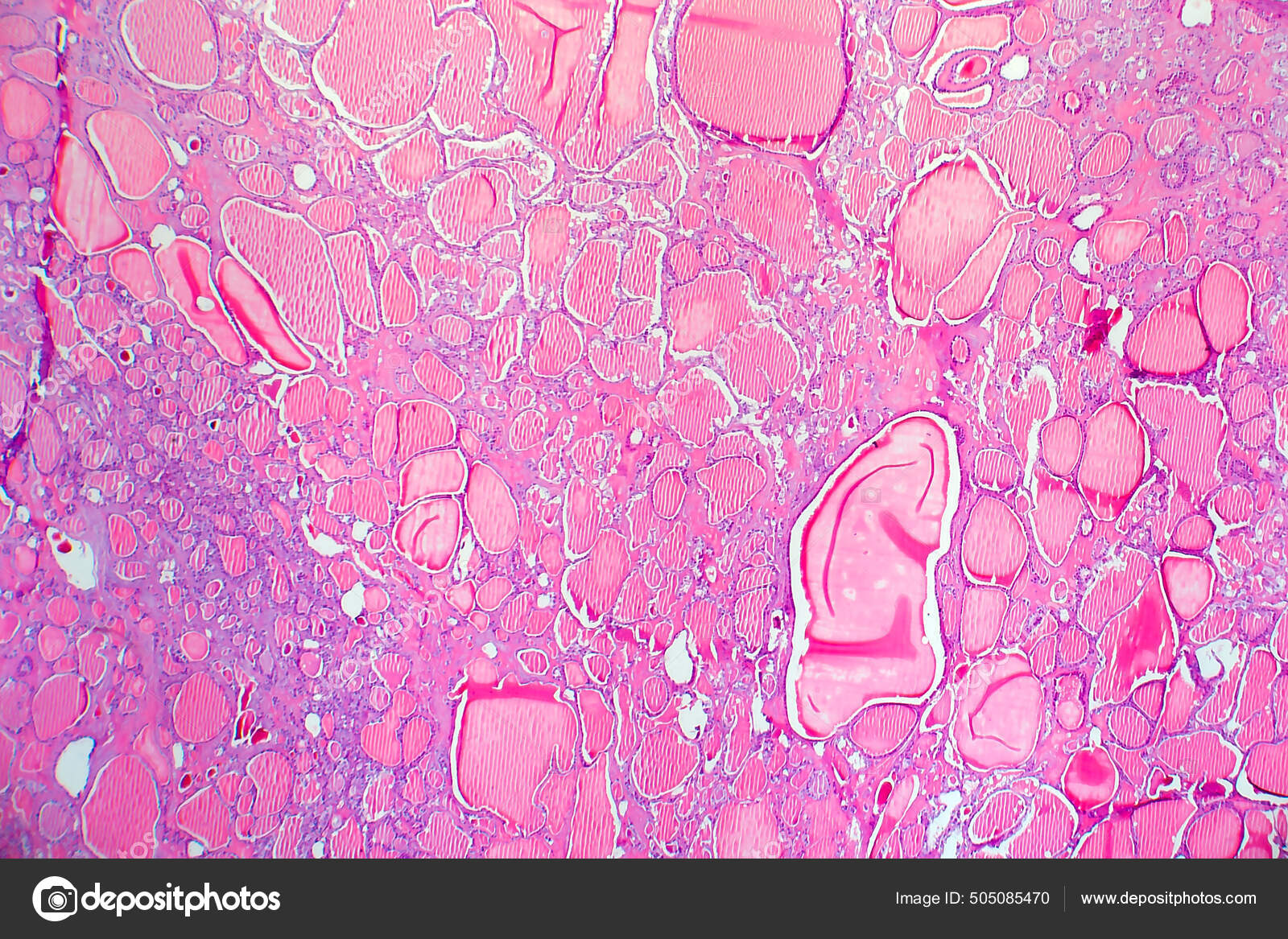 Follicular Adenoma Thyroid Gland Light Micrograph Histopathology
