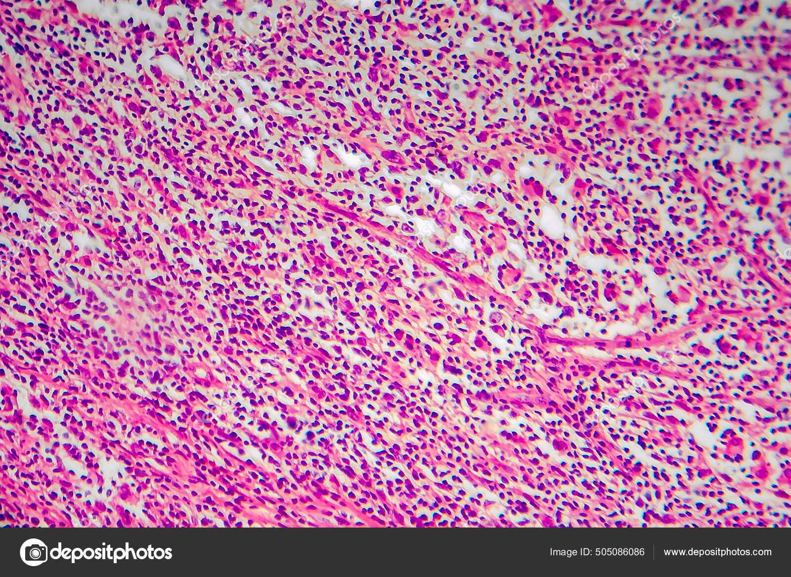 Hodgkin Lymphoma Light Micrograph Photo Microscope Type Lymphoma Which ...