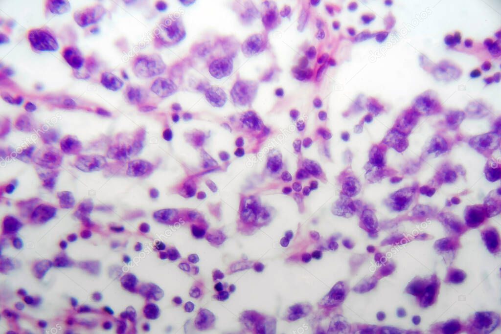 Seminoma testicular, micrograf a ligera, foto bajo el microscopio ...