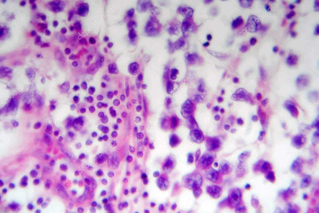 Seminoma testicular, micrograf a ligera, foto bajo el microscopio ...