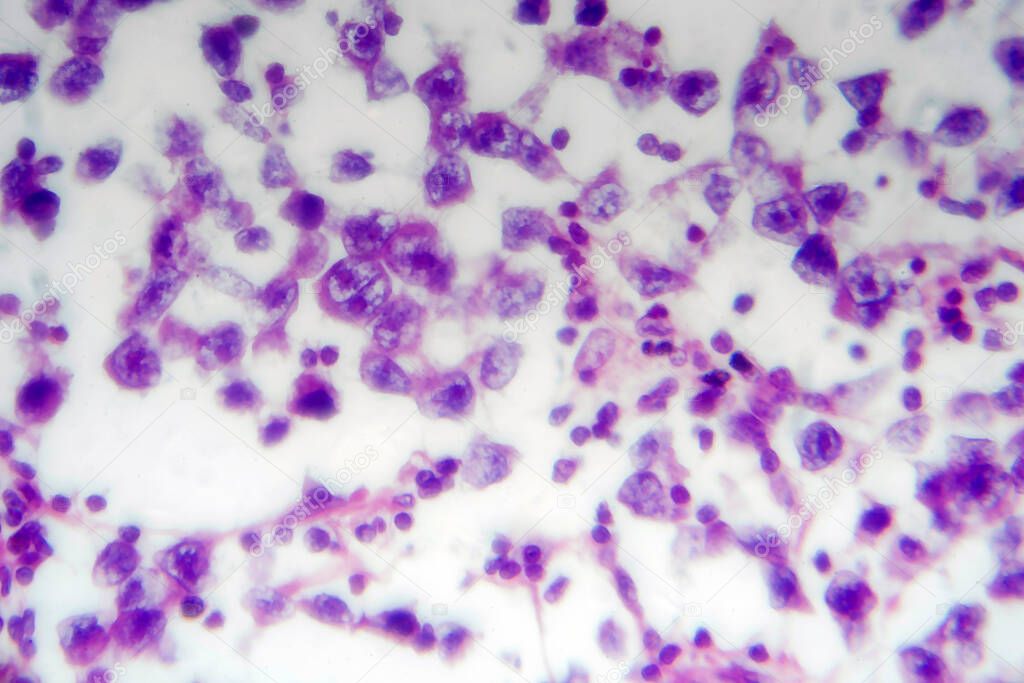 Seminoma Testicular Micrografía Ligera Foto Bajo El Microscopio