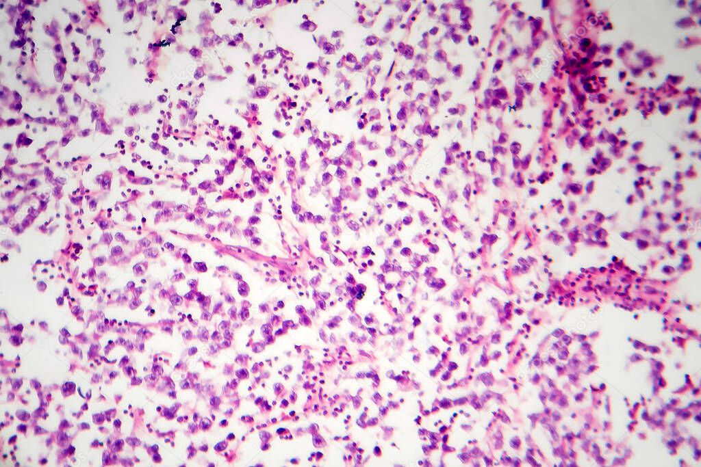 Seminoma testicular, micrograf a ligera, foto bajo el microscopio ...
