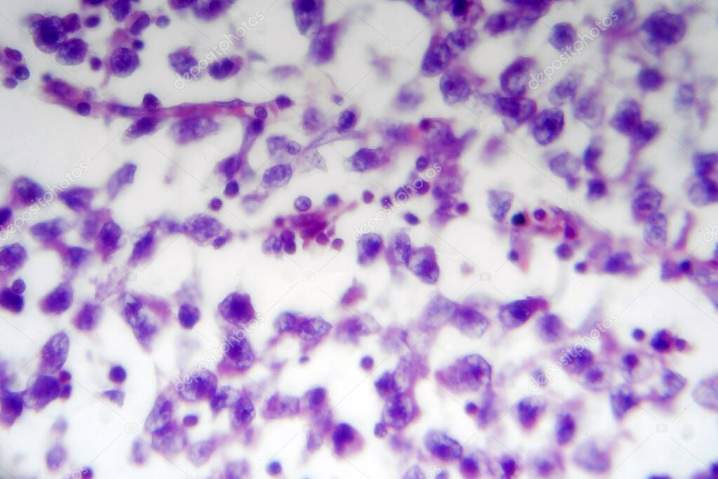Seminoma testicular, micrograf a ligera, foto bajo el microscopio ...