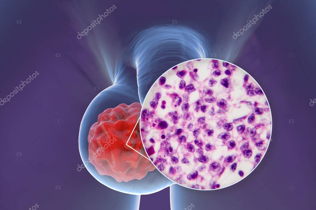 Cáncer Testicular Seminoma Testicular Ilustración Médica 3d Y