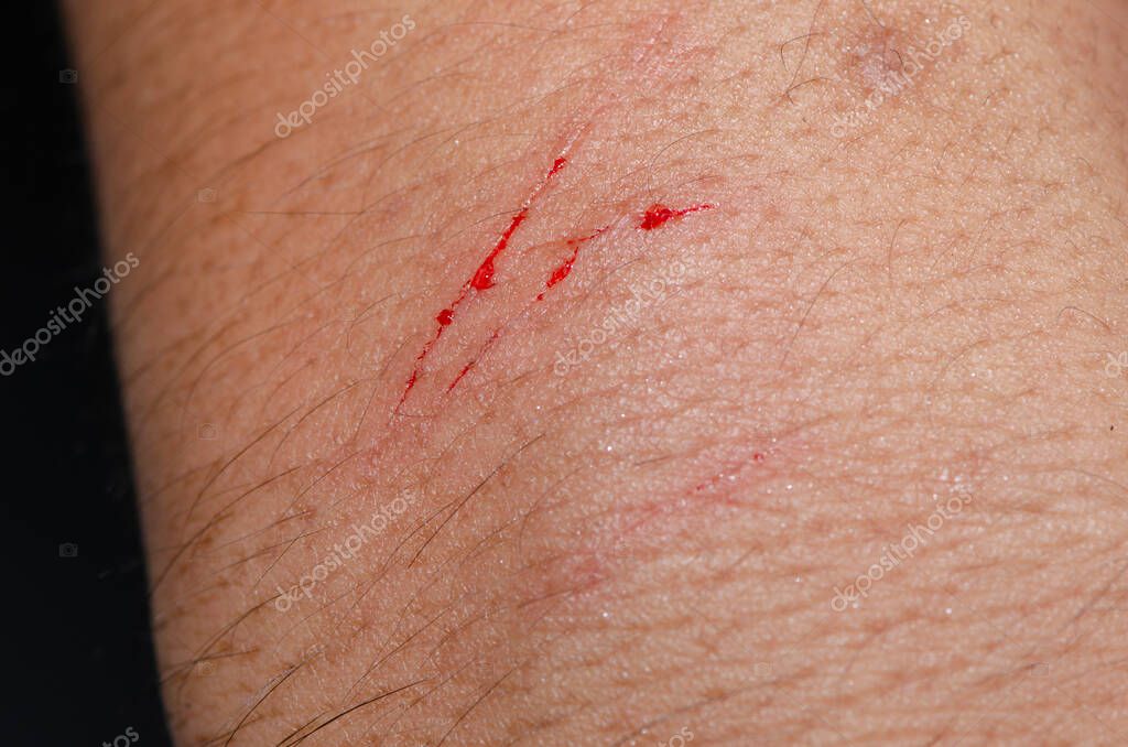 Lesiones por caída en el jardín. Un hombre mostrando una lesión en su ...