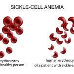 Sickle cell anemia Stock Vector Image by ©rob3000 #76383393