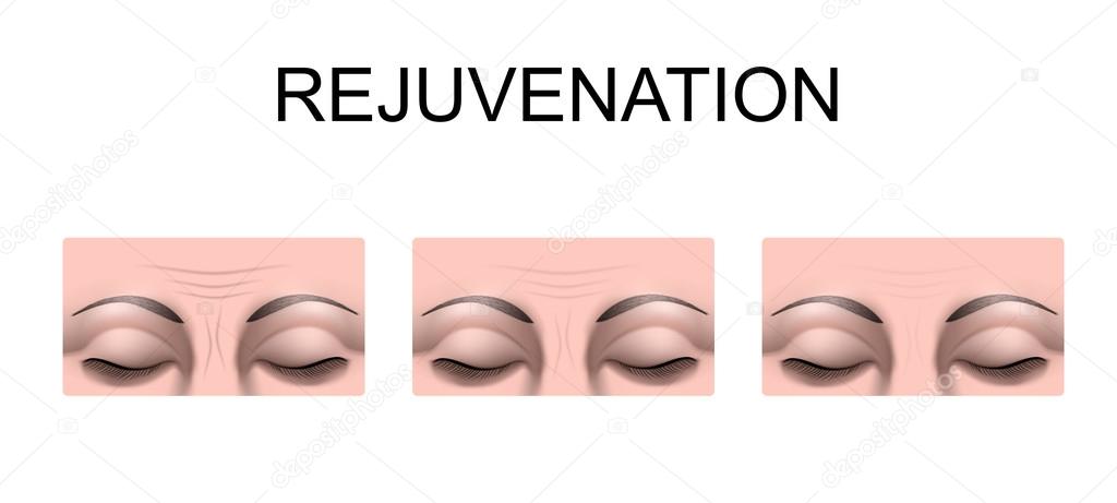 Wrinkles on the forehead. rejuvenation. plastic surgery Stock Vector by ...