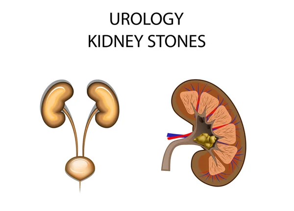 24,750,220 Kidney stones Stock Illustrations | Depositphotos
