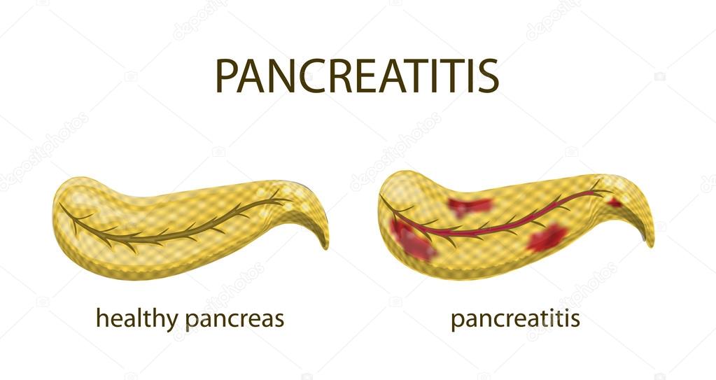 Pancreas healthy and pancreatitis — Stock Vector © Artemida-psy #81080844