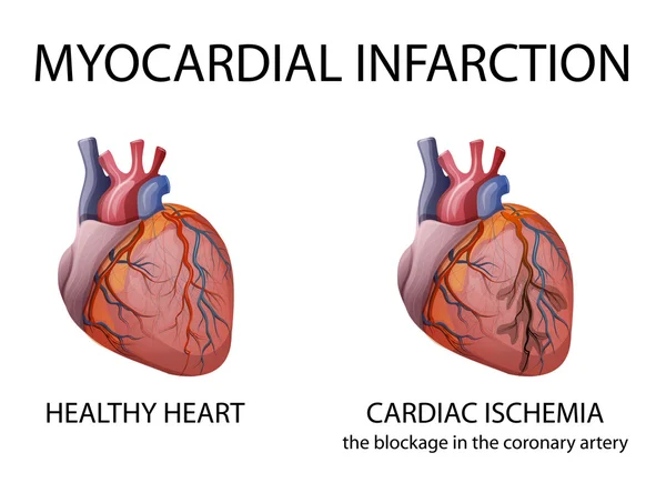 Myocardial infarction Stock Vectors, Royalty Free Myocardial infarction ...