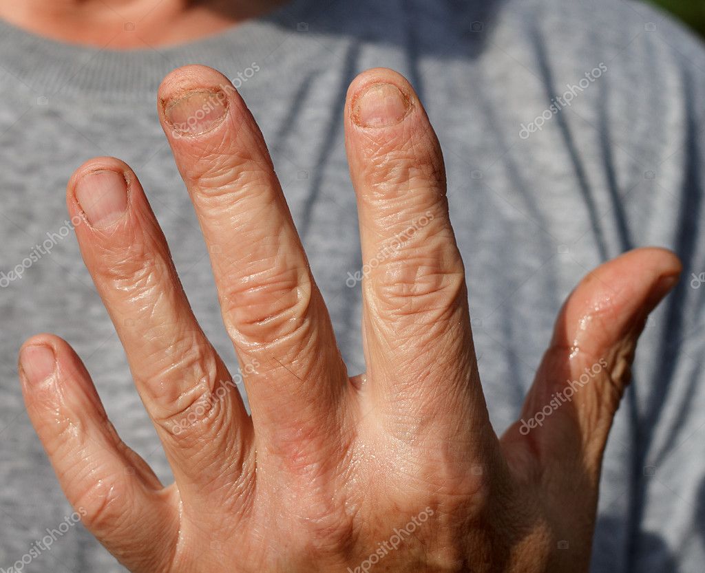 Images Of Beriberi Disease Beriberi: Understanding The Deficiency