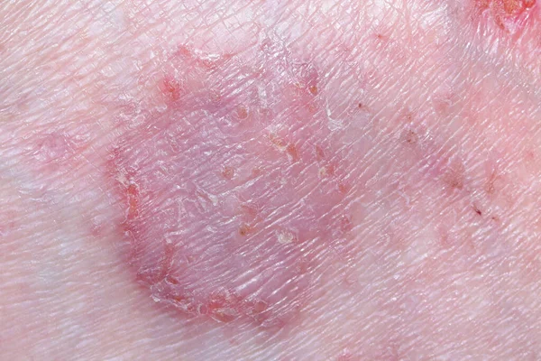 Ulcere cutanee Stock Photos, Royalty Free Ulcere cutanee Images ...