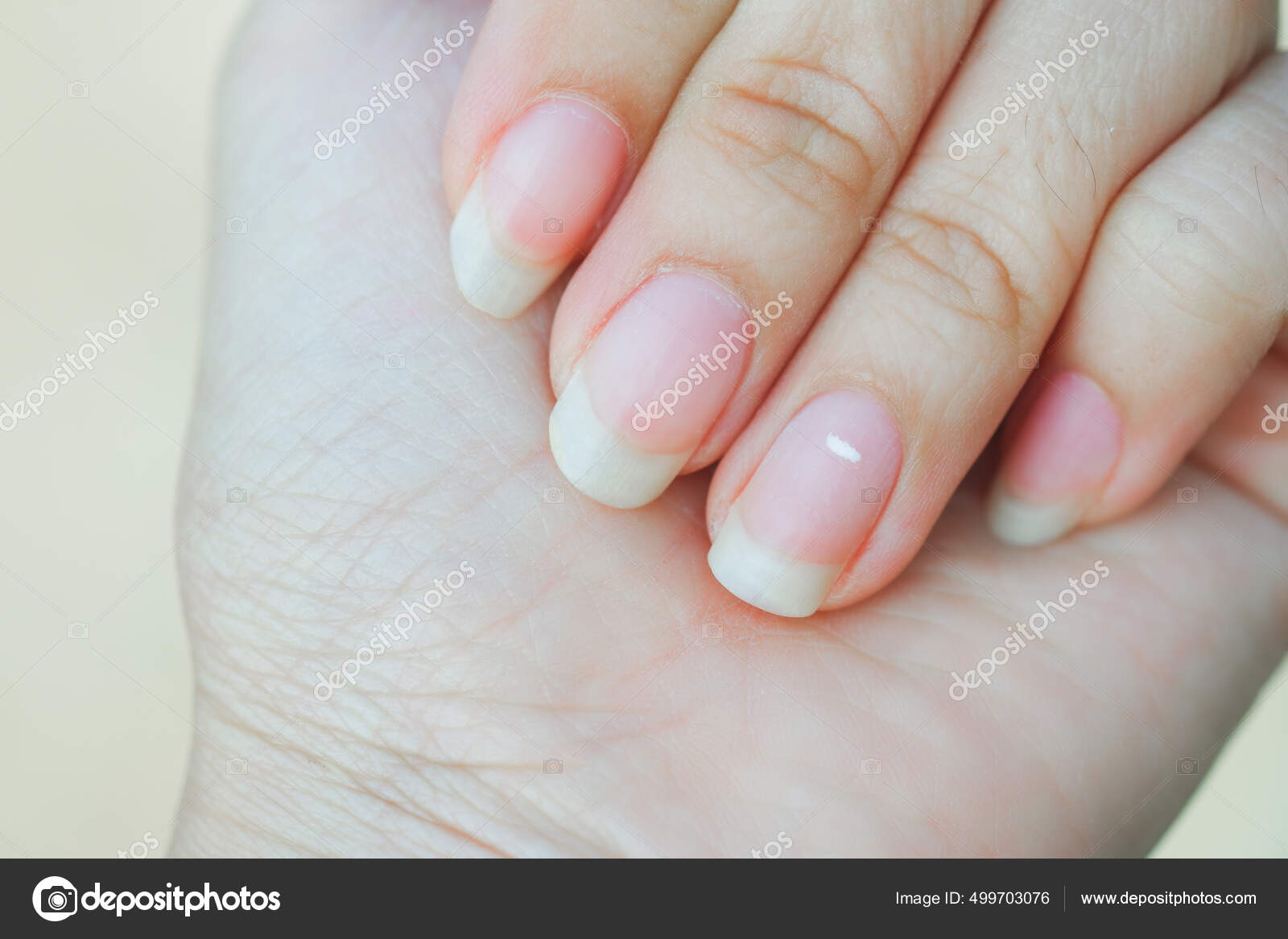 White Spots Finger Nails Called Leukonychia Reveal Emergence Health ...
