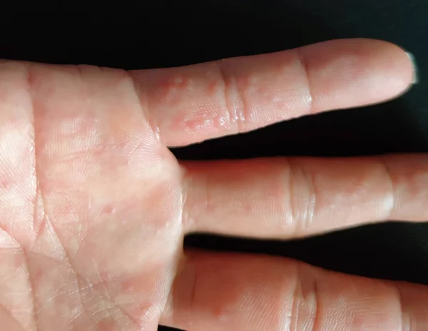 Dyshidrotic eczema Pictures, Dyshidrotic eczema Stock Photos & Images ...