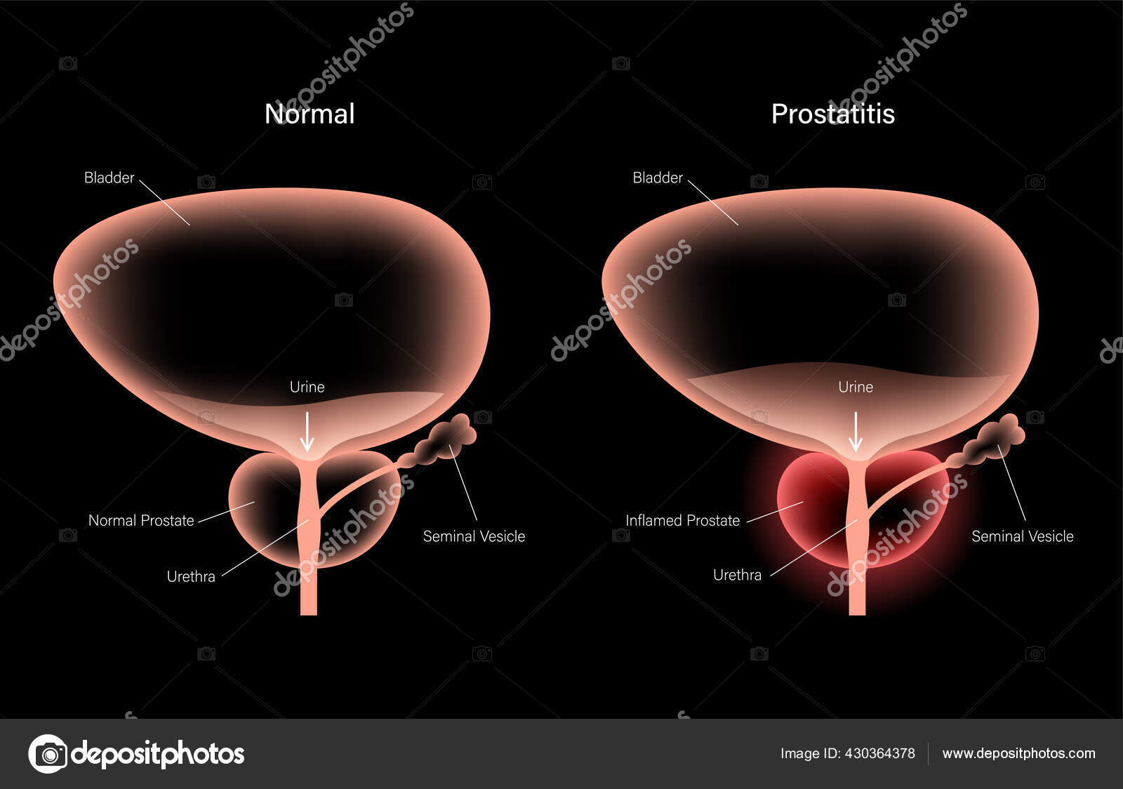 Prostatitis inflammation problem Stock Vector Image by ©Pikovit #430364378