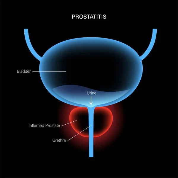 Prostate cancer concept Stock Vector by ©Pikovit 433159360