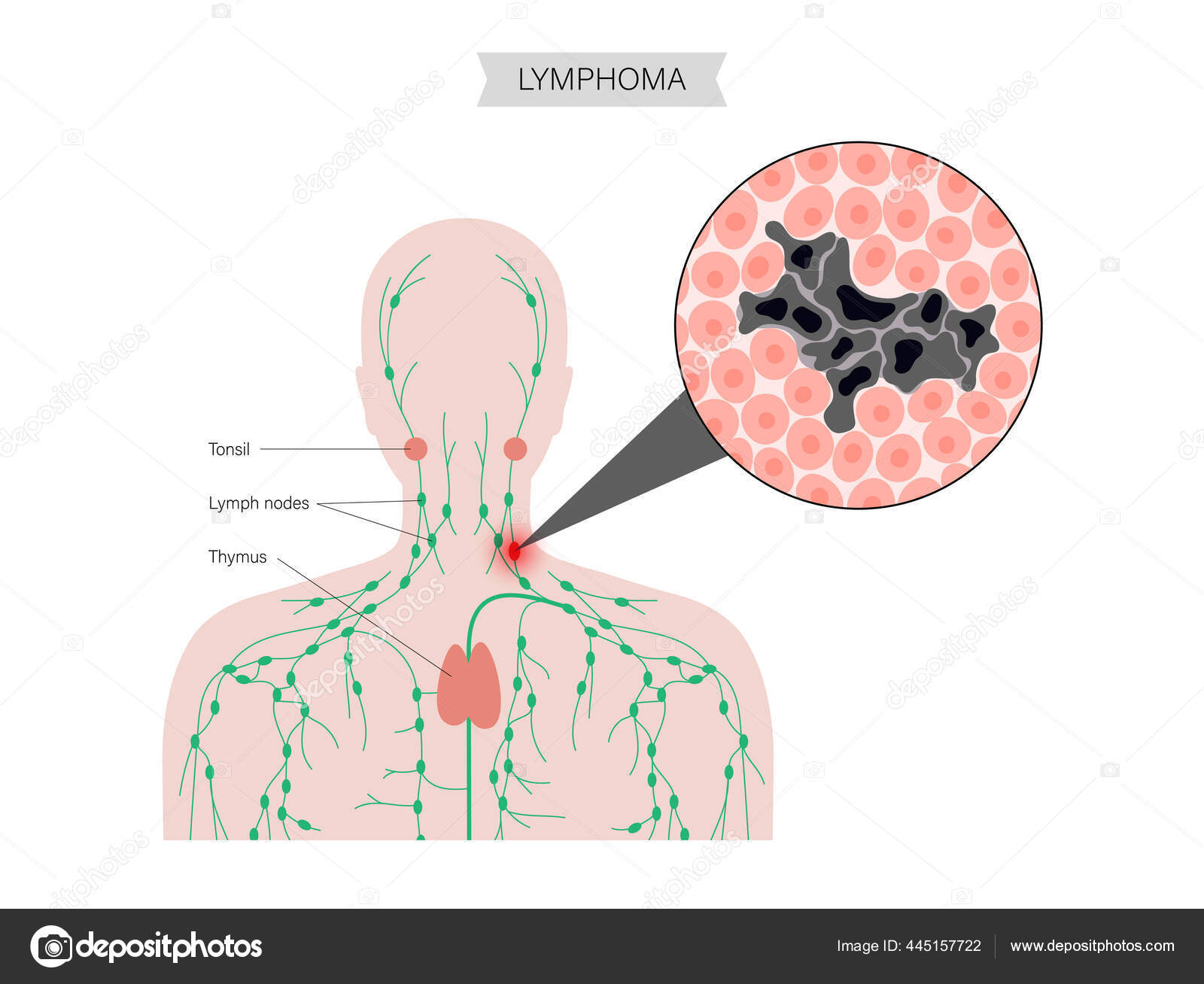 Concepto de cáncer de linfoma vector, gráfico vectorial © Pikovit ...