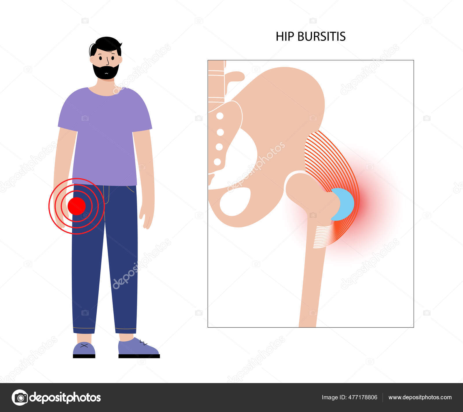 Bursitis inflammation concept Stock Vector by ©Pikovit 477178806