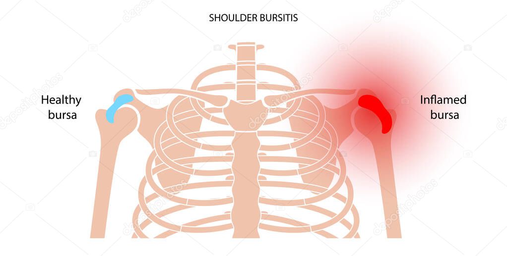 Concepto de inflamación de bursitis Vector de Stock de ©Pikovit 477179078