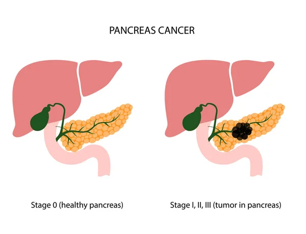 100,000 Cancer du pancréas Vector Images | Depositphotos