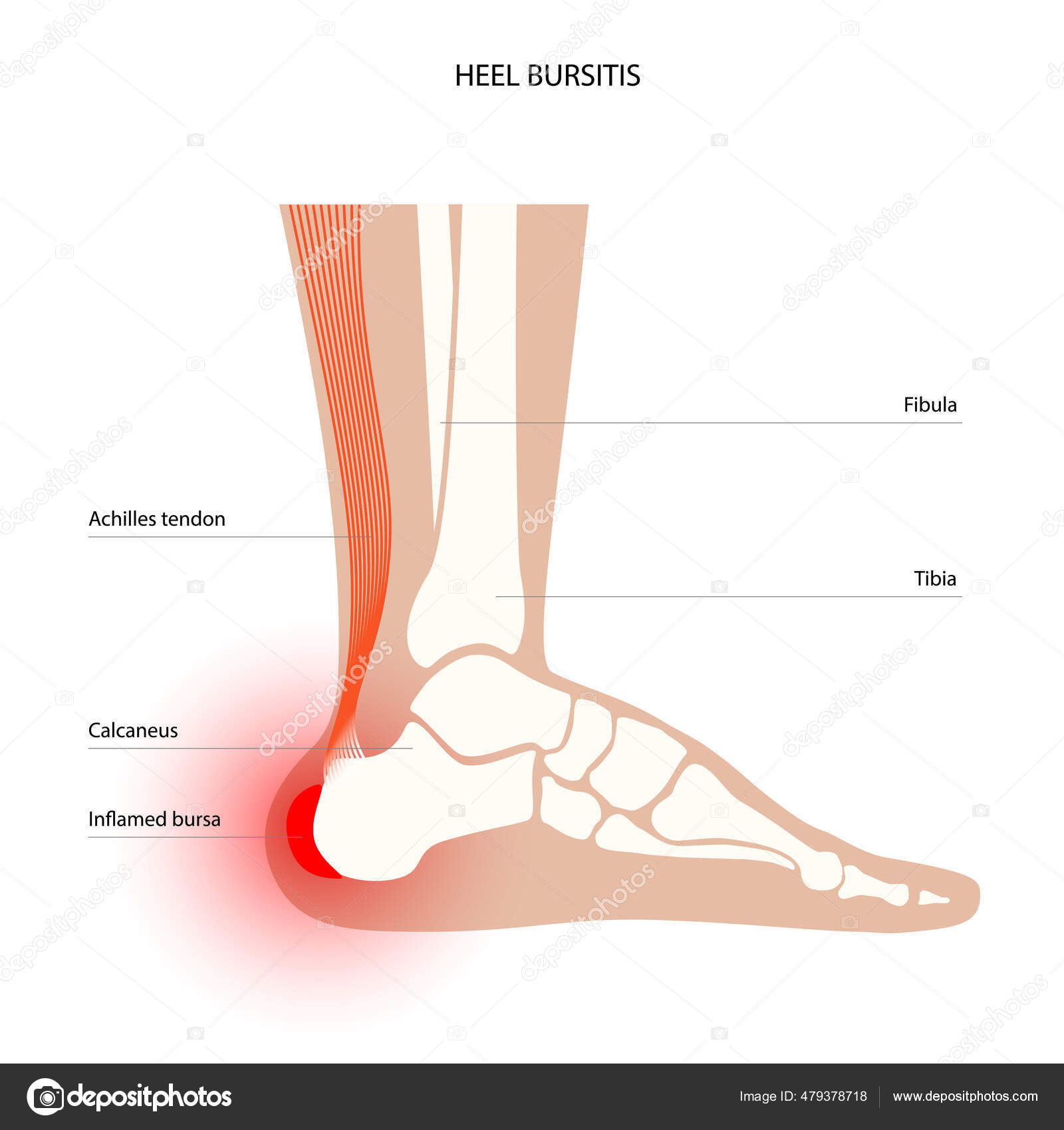 Bursitis inflammation concept Stock Vector Image by ©Pikovit #479378718