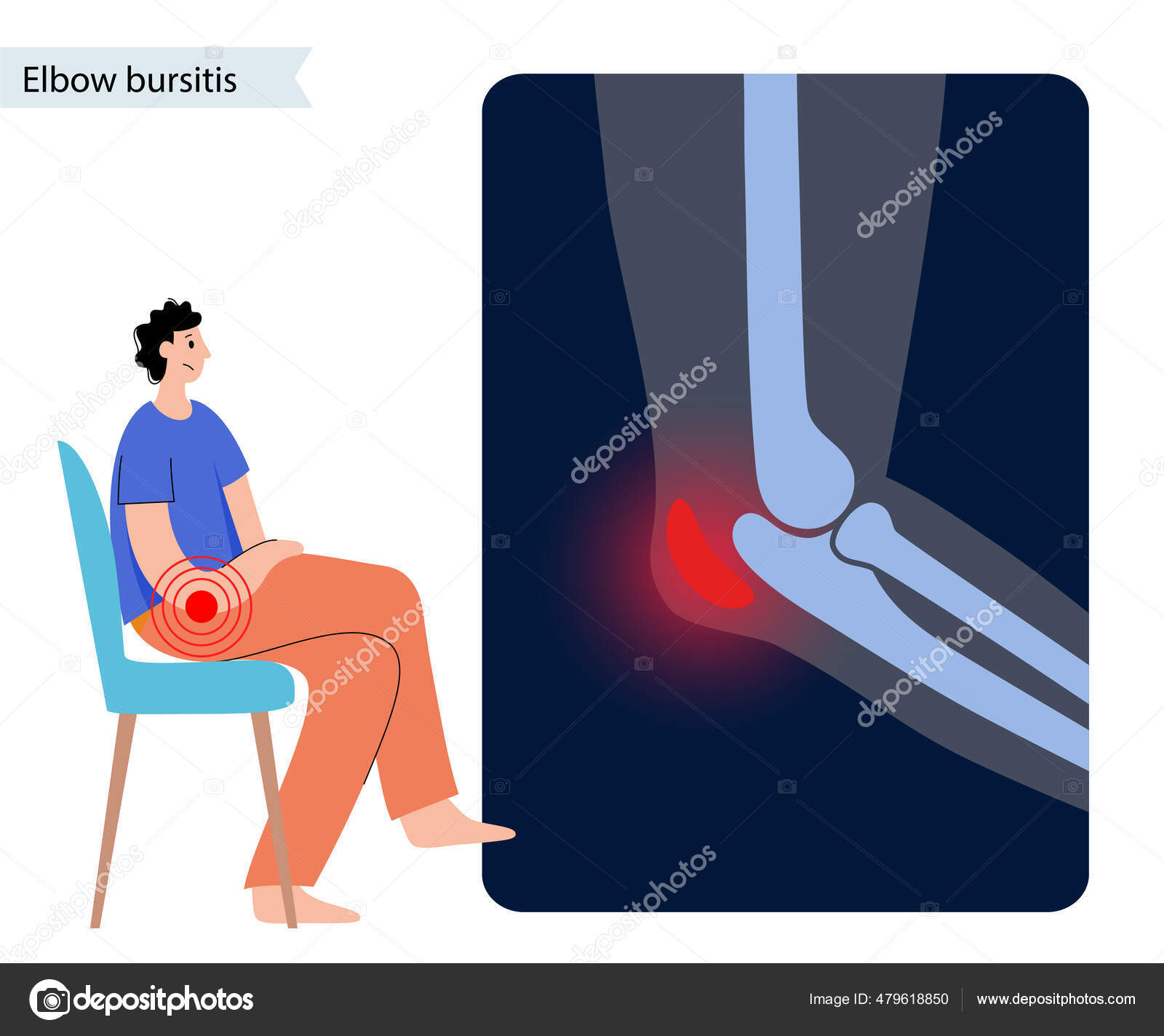 Student elbow bursitis Stock Vector by ©Pikovit 479618850