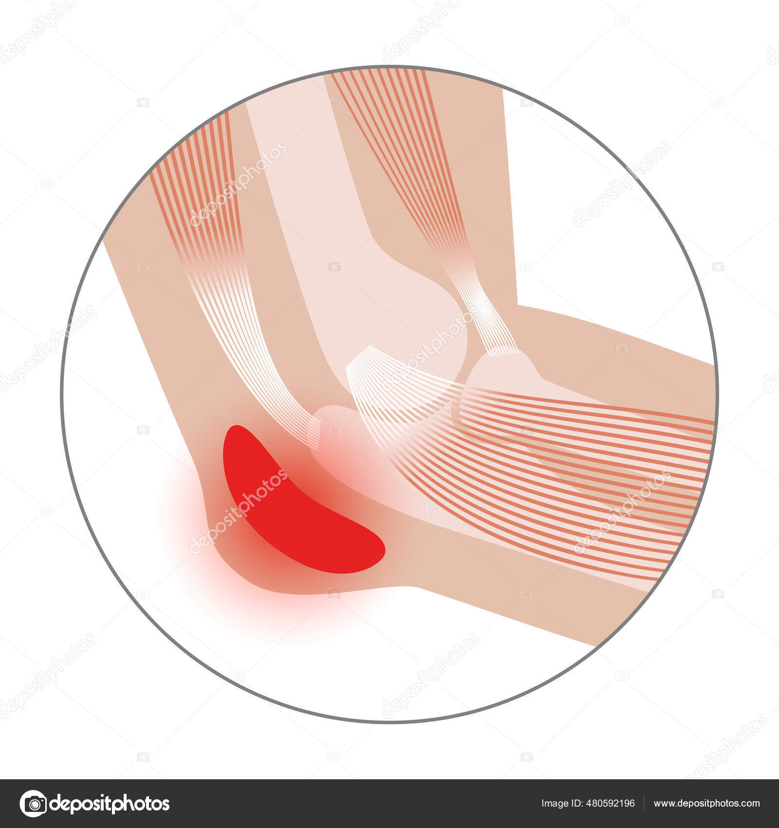 Student elbow bursitis Stock Vector by ©Pikovit 480592196
