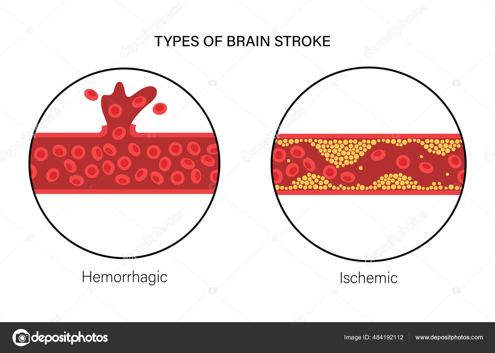 Brain stroke ishemic and hemorrhagic Stock Vector by ©Pikovit 484192112