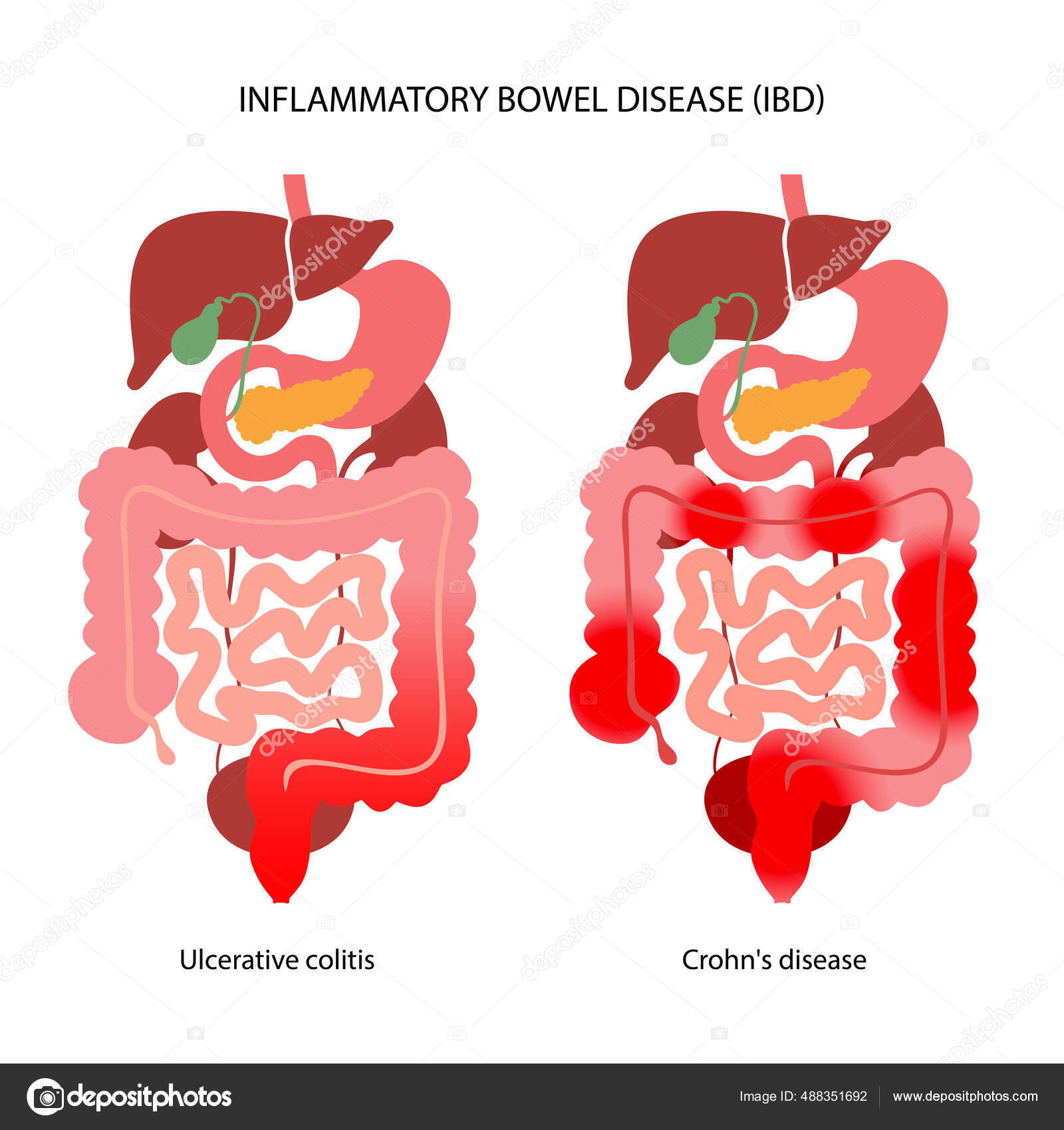 Enfermedad inflamatoria intestinal vector, gráfico vectorial © Pikovit ...