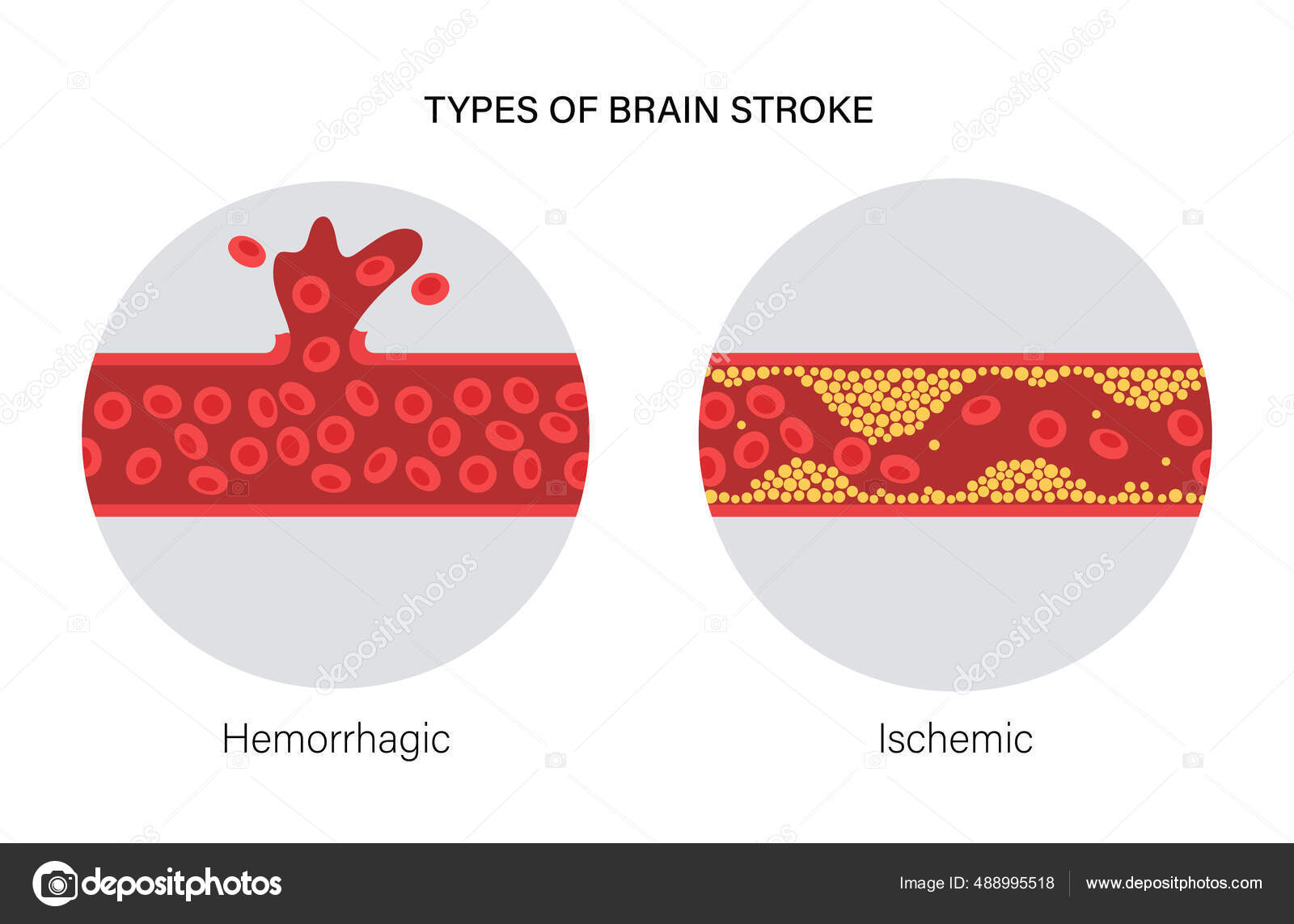 Brain stroke ishemic and hemorrhagic Stock Vector by ©Pikovit 488995518