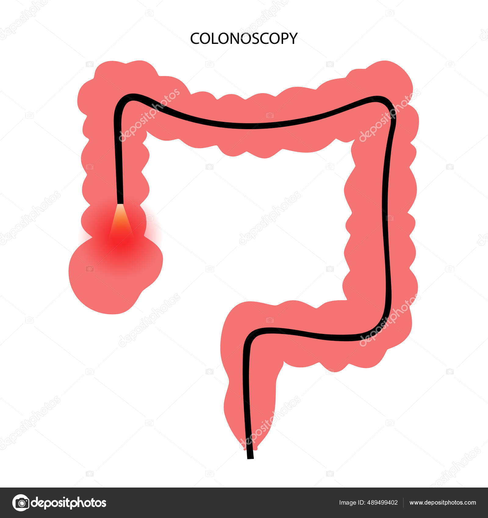Colonoscopy procedure concept Stock Vector Image by ©Pikovit #489499402