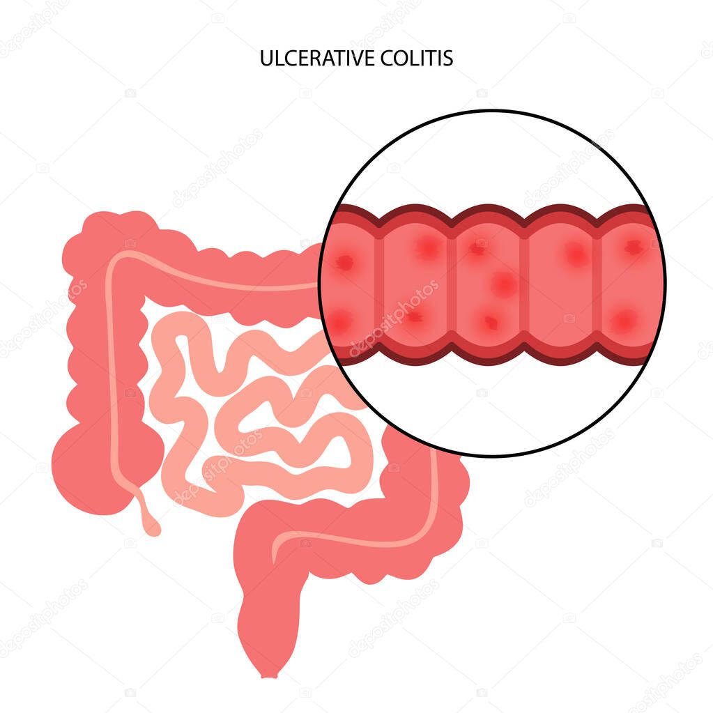 Colitis ulcerosa intestinal Vector de stock por ©Pikovit 489499750
