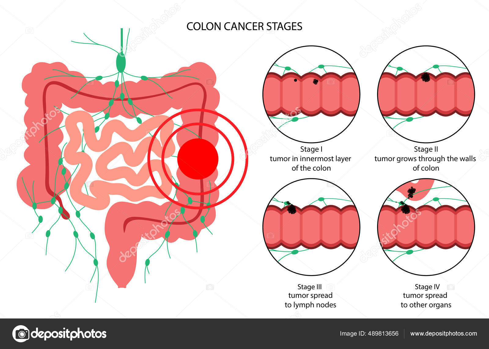 Estágio de câncer de cólon — Vetor de Stock © Pikovit #489813656
