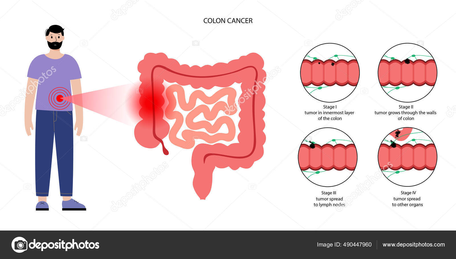 Colon cancer stage Stock Vector by ©Pikovit 490447960