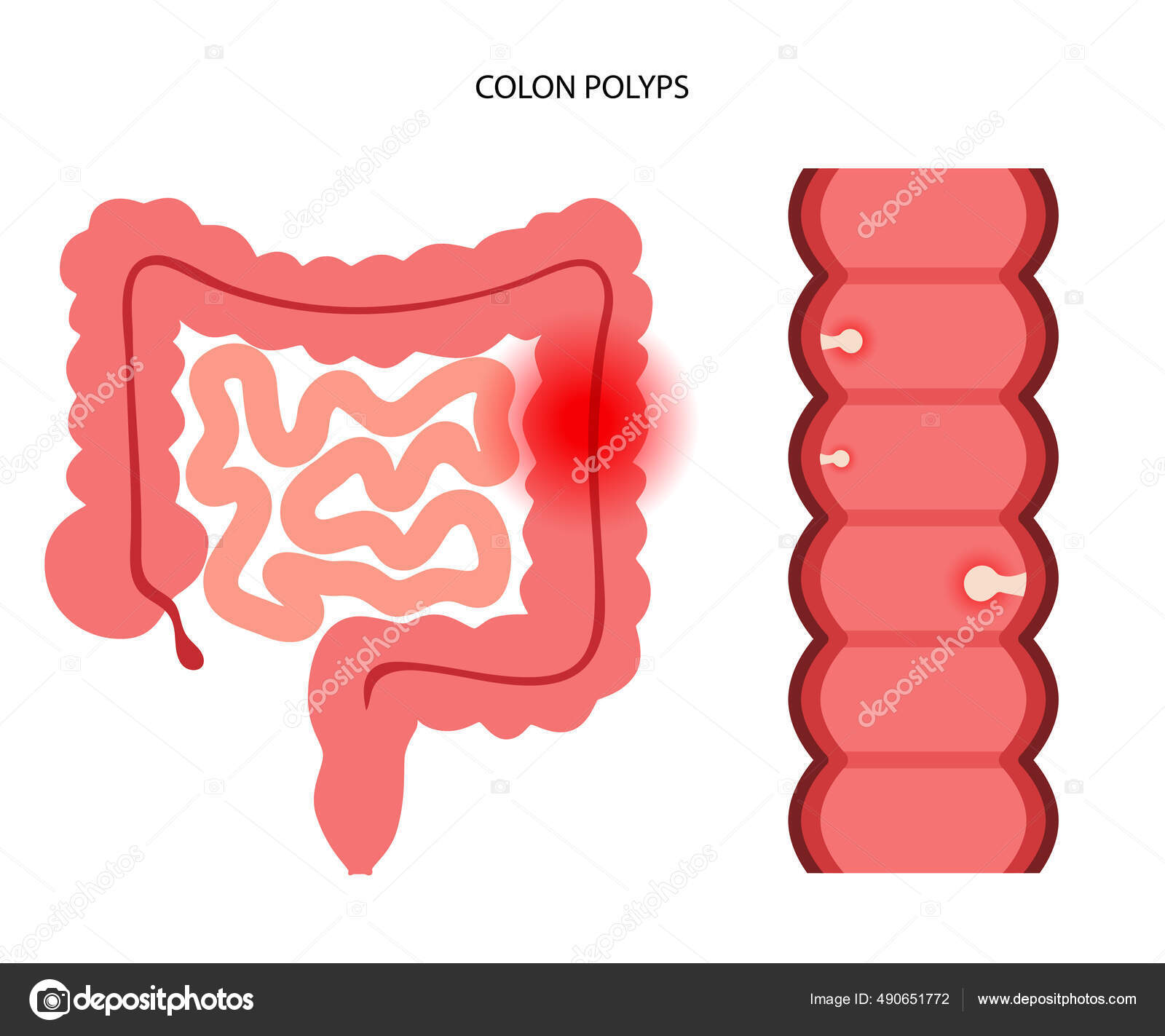 Colon polyps inflammation Stock Vector Image by ©Pikovit #490651772
