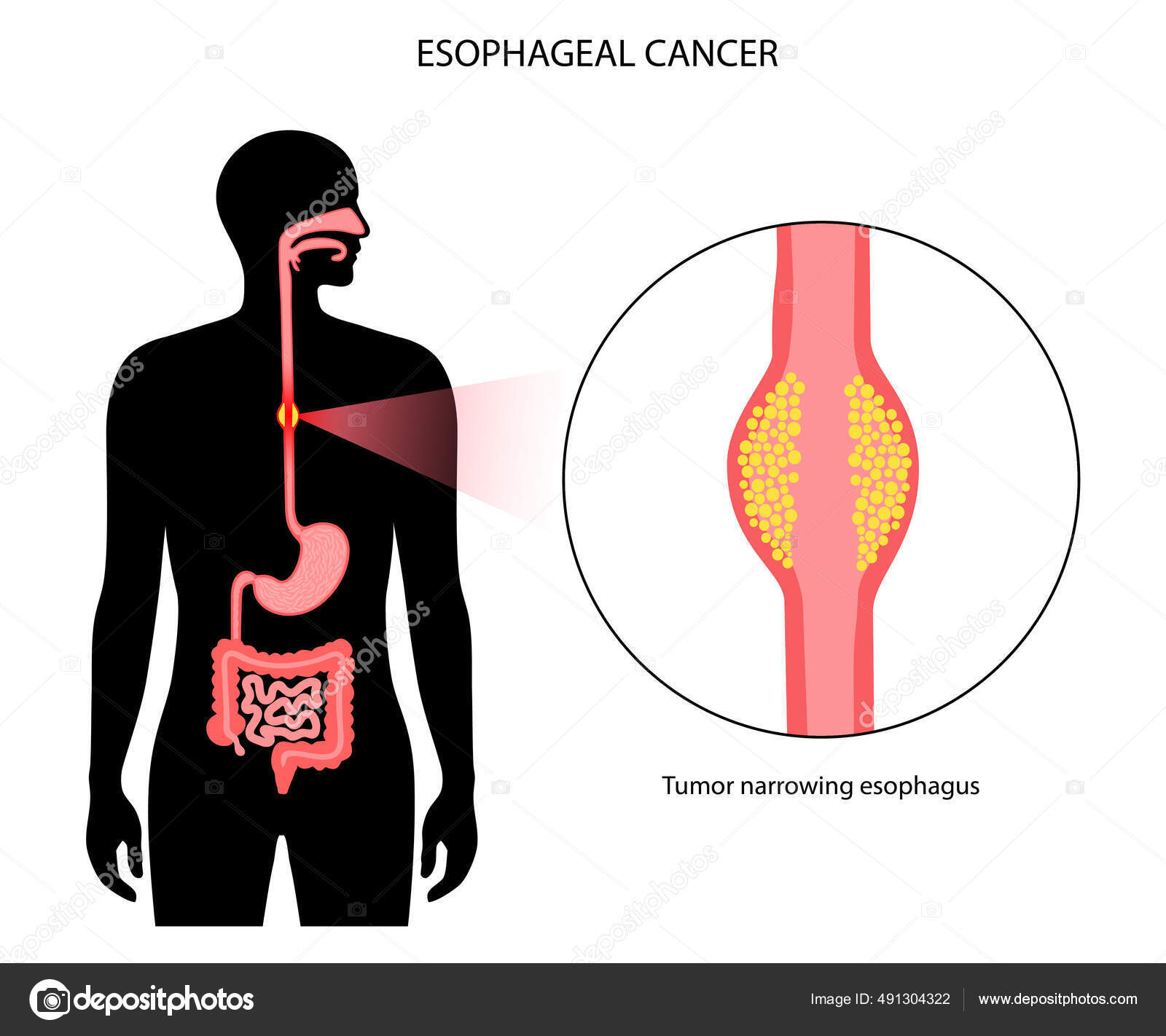kanser esofagus (esophageal cancer) - Peter Lambert