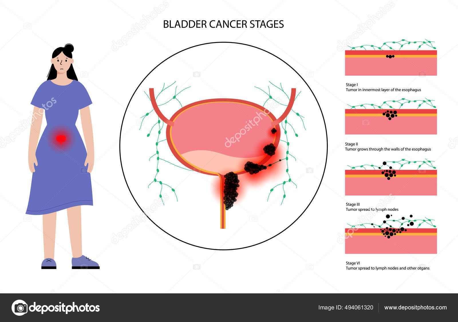 Bladder cancer stages Stock Vector Image by ©Pikovit #494061320