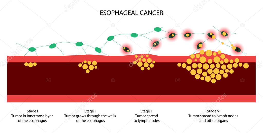 estadios del cáncer de esófago 2023