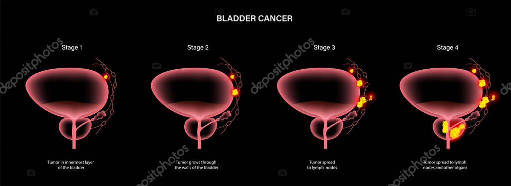 Stages of bladder cancer Vector Art Stock Images | Depositphotos