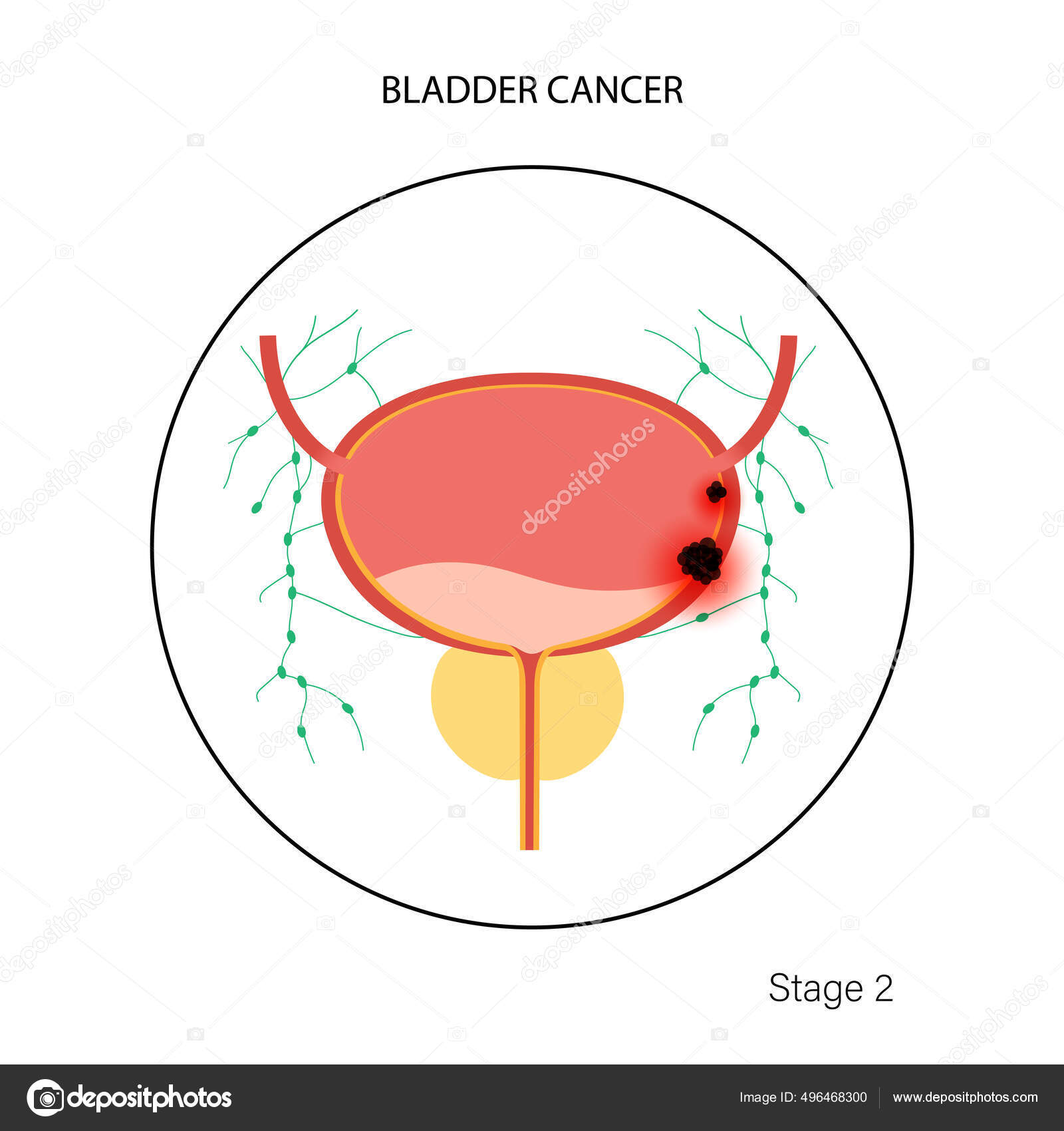 Bladder cancer stages Stock Vector by ©Pikovit 496468300