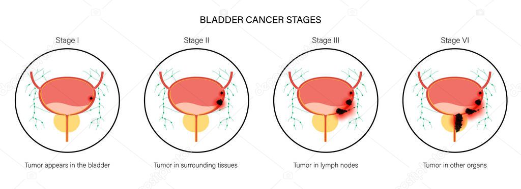 Stages of bladder cancer Vector Art Stock Images | Depositphotos