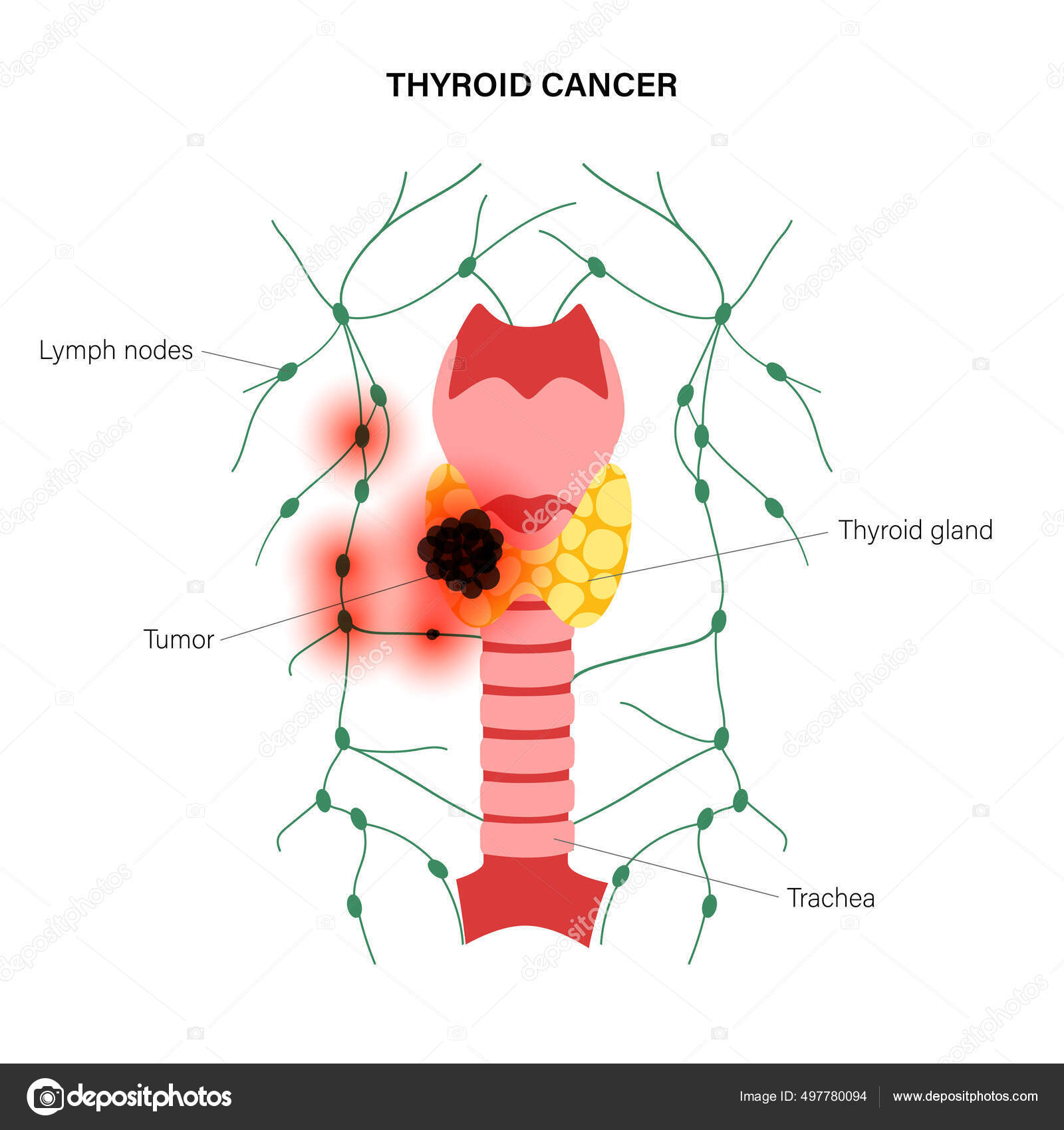 Thyroid cancer stages Stock Vector by ©Pikovit 497780094
