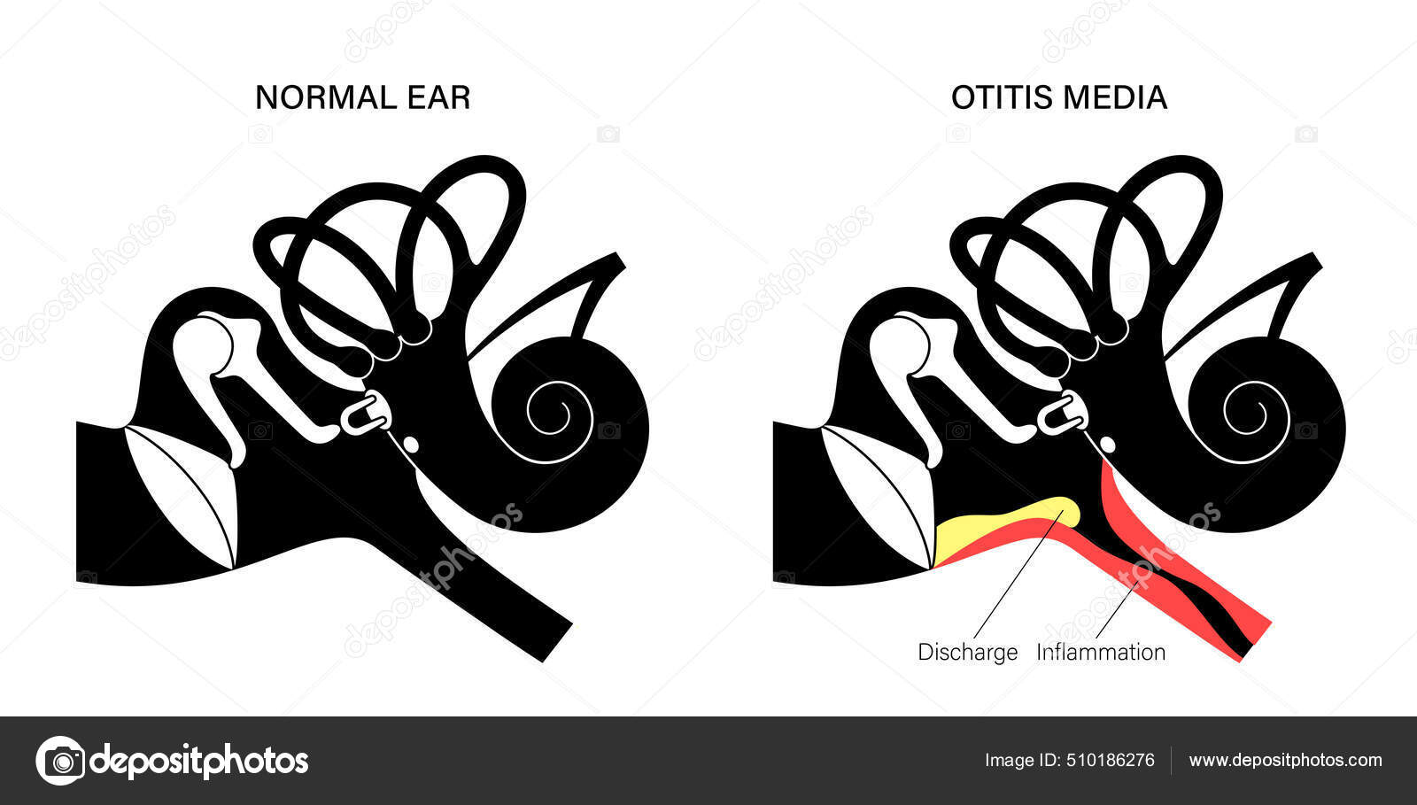 Otitis media disease Stock Vector Image by ©Pikovit #510186276
