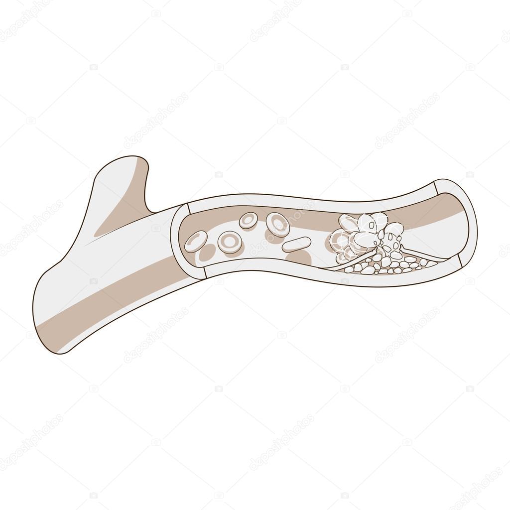 Blood vessel and clot thrombus vector illustration — Stock Vector ...